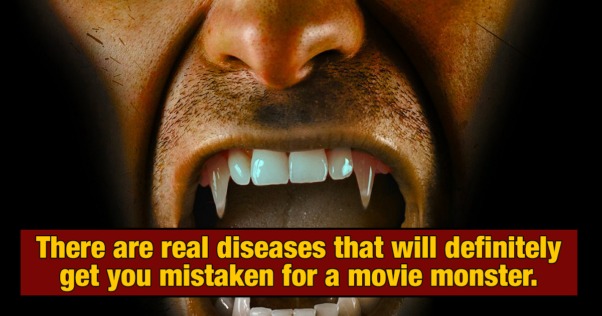 23 Horrifying Diseases That Sound Like Something Out Of A Movie ...